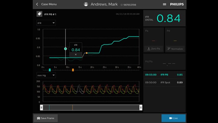 Percutaneous Coronary Intervention (PCI) | Philips Healthcare