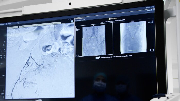 Prostate Artery Embolization (PAE) | Philips